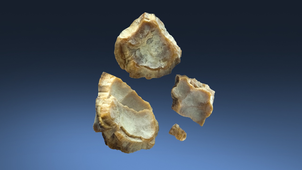 Breaking Down Stone Surgery with Lithotripsy: Modern Approaches to ...